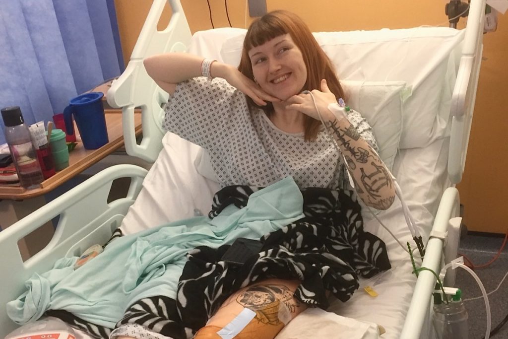 Woman who lost leg to cancer raising money for state of the art ...